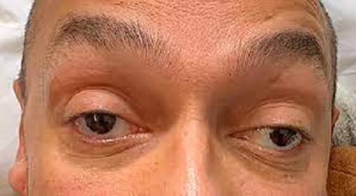 Botulizm Nedir? Belirtileri Nelerdir ? | Bilgio.Net